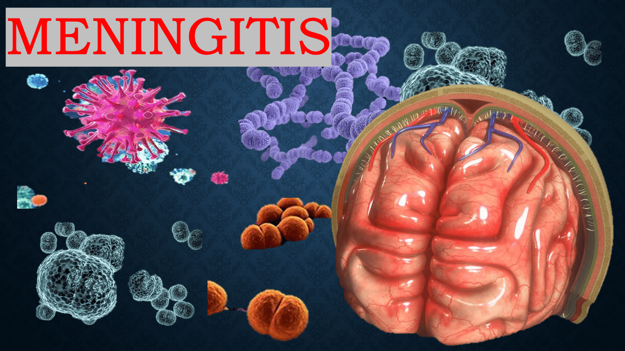 Meningitis Pictorial Presentation - NeuroHealth