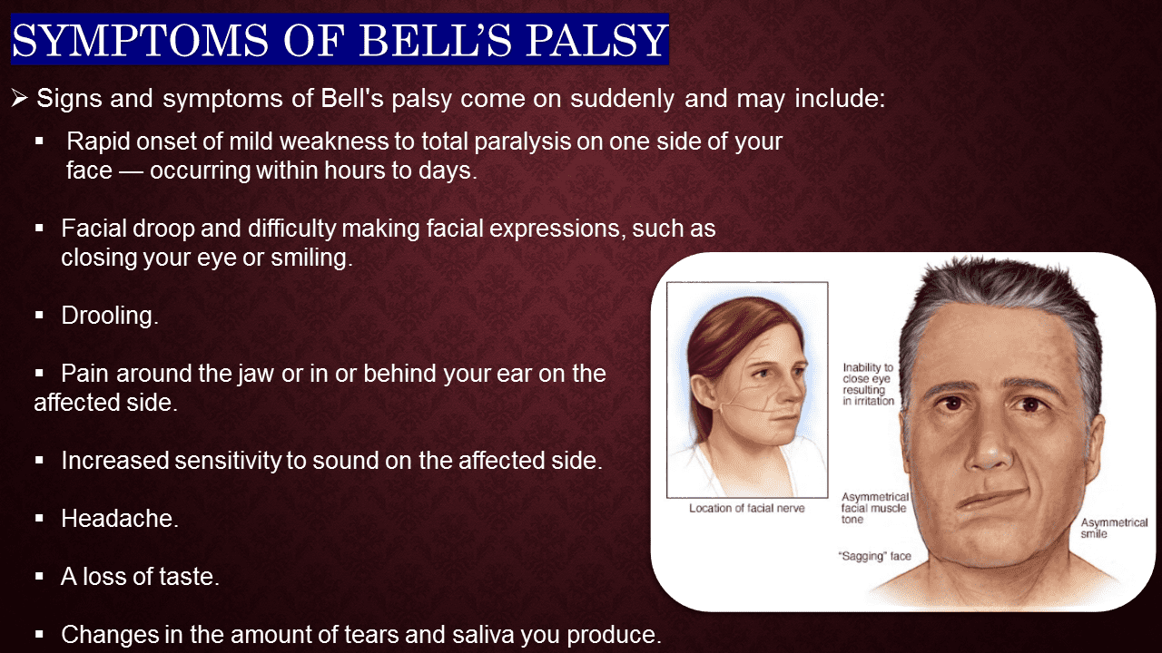 Have you heard of Bell’s Palsy? Know the details - NeuroHealth
